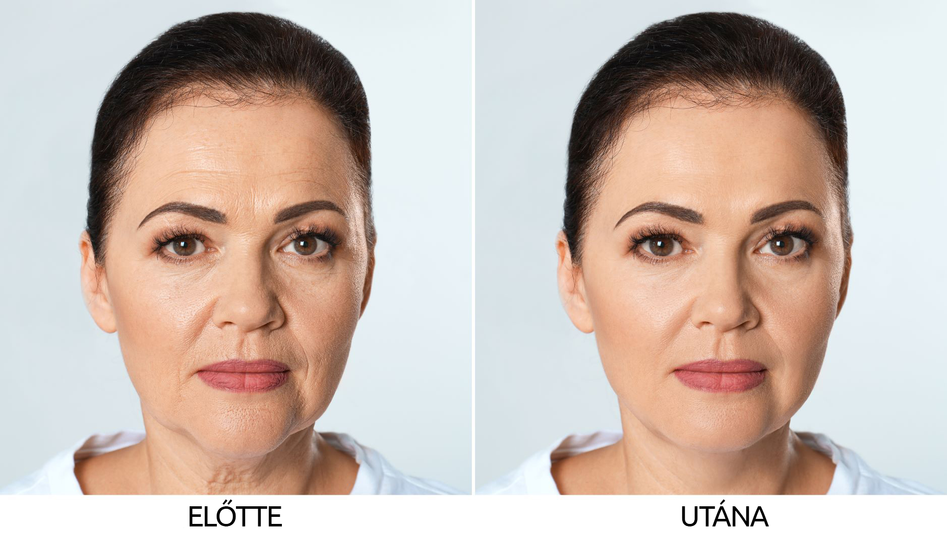 PROFHILO® – BIO REMODELING - Halas Medical